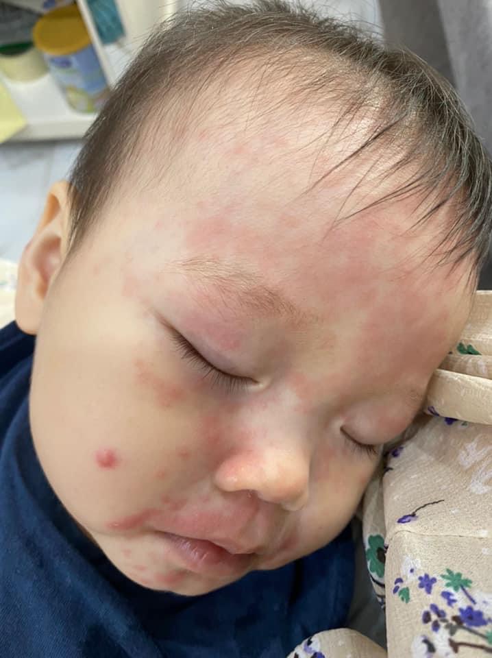 C??ch ch??m s??c tr??? s???t ph??t ban ????ng c??ch t???i nh?? - Y D ...